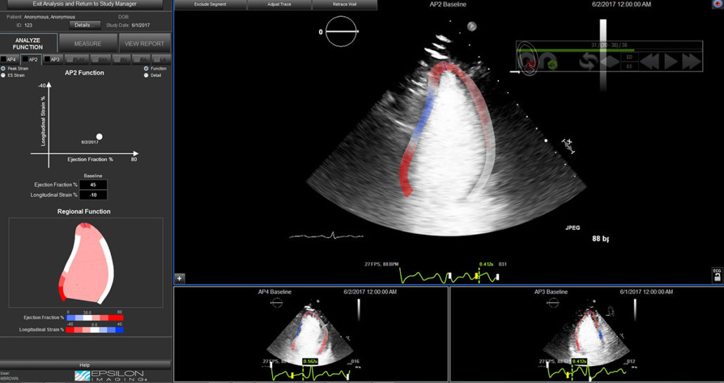 EchoInsight Application: Left Ventricle Contrast - Epsilon Imaging
