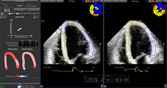 EchoInsight Application: Stress Echo - Epsilon Imaging